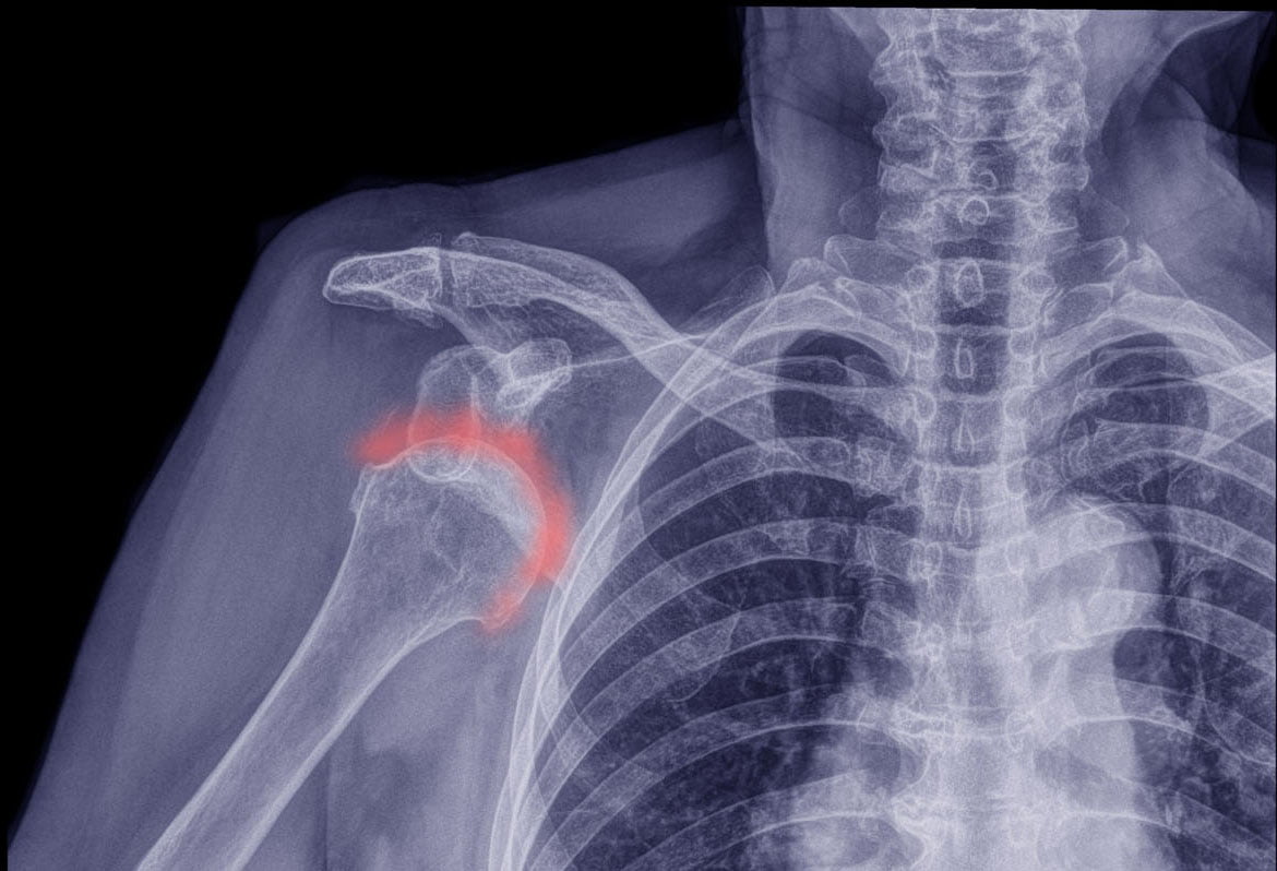 MTS1 - Adult - My Total Shoulder, Inc